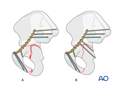 ORIF through modified Stoppa approach for T-type