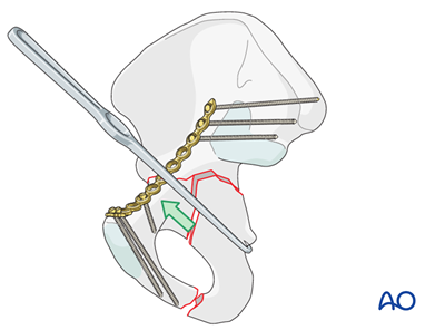 ORIF through modified Stoppa approach for T-type