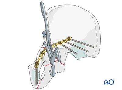 ORIF through modified Stoppa approach for T-type