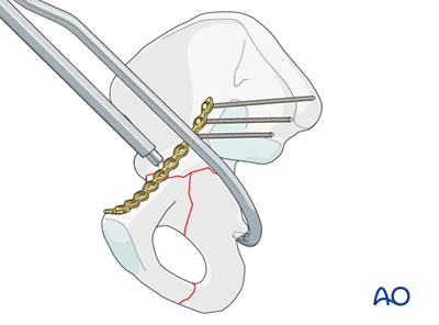 ORIF through modified Stoppa approach for T-type