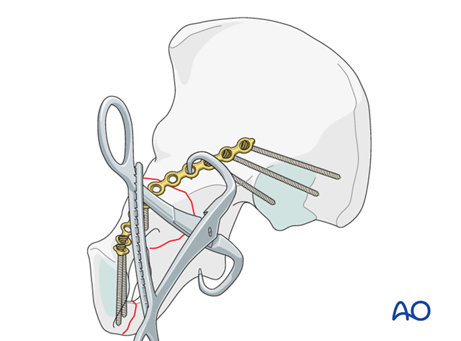 ORIF through modified Stoppa approach for T-type