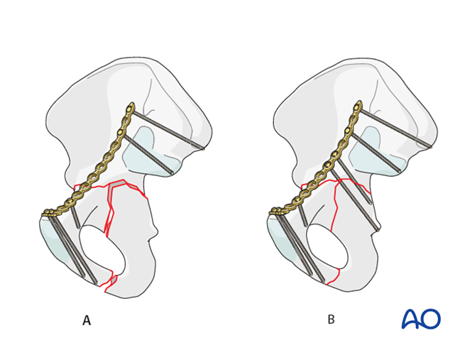 ORIF through ilioinguinal approach for T-type