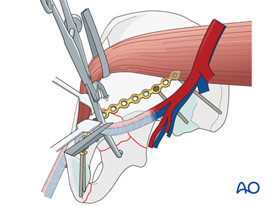 ORIF through ilioinguinal approach for T-type