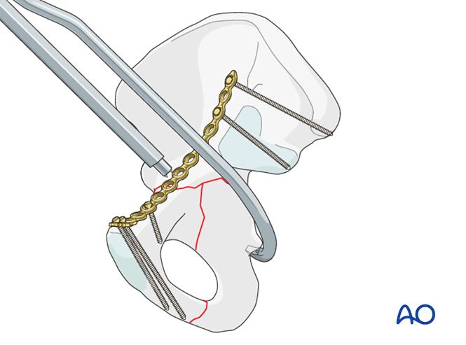 ORIF through ilioinguinal approach for T-type