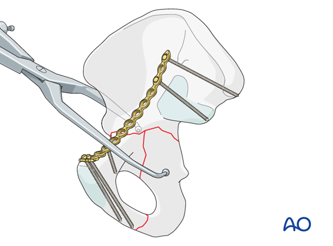 ORIF through ilioinguinal approach for T-type