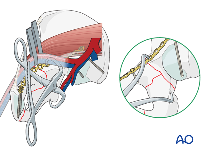 ORIF through ilioinguinal approach for T-type