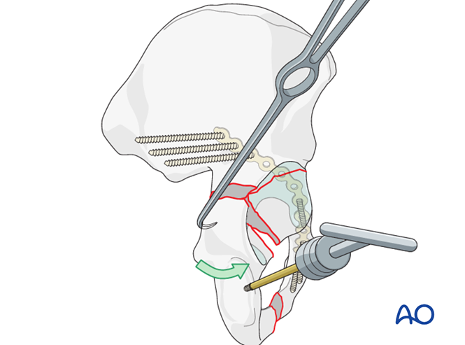 ORIF through sequential approaches for T-type