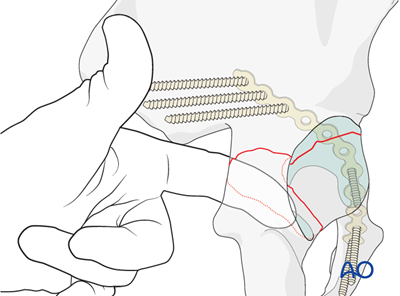 ORIF through sequential approaches for T-type