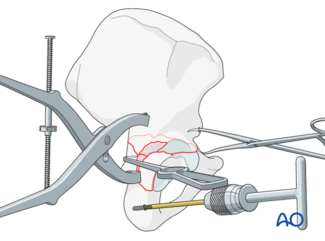 ORIF through extended iliofemoral approach for Transverse and posterior ...