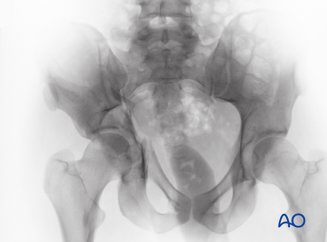 Radiology of the intact acetabulum