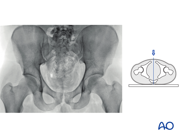 X Ray Pelvis Both Hip Ap Clearance Stores