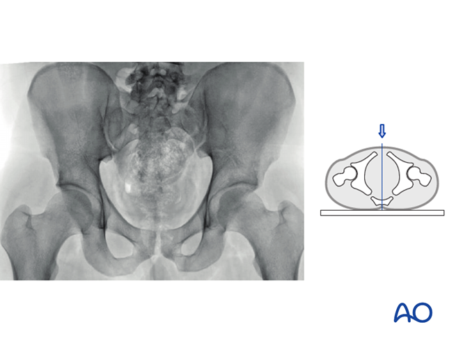 Radiology of the intact acetabulum