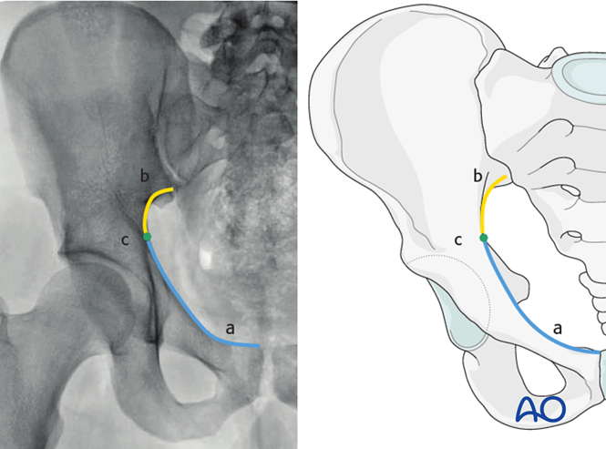 Radiology of the intact acetabulum