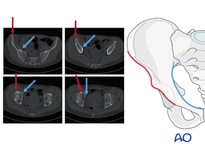 Radiology of the intact acetabulum