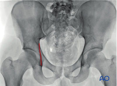 Radiology of the intact acetabulum