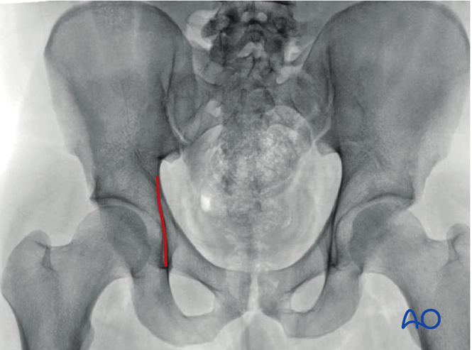 Radiology of the intact acetabulum