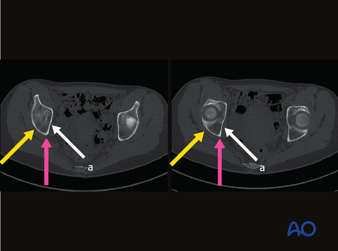 Radiology of the intact acetabulum