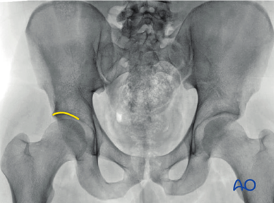 Radiology of the intact acetabulum