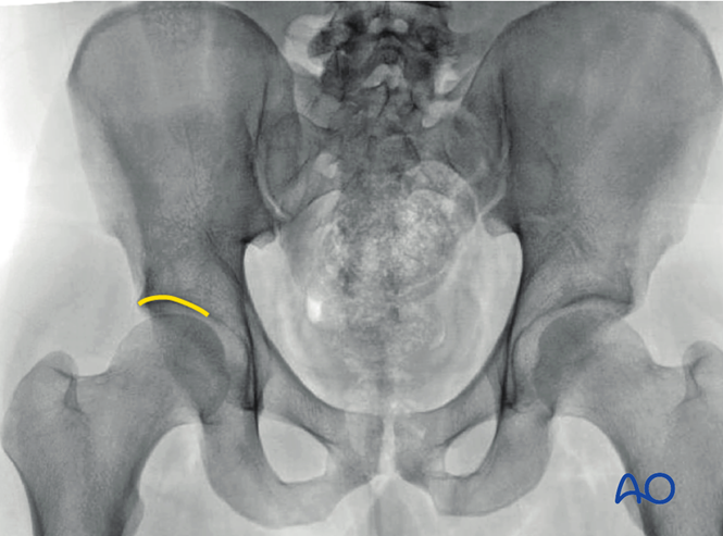 Radiology of the intact acetabulum