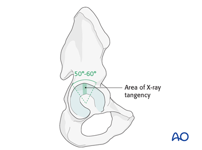 Radiology of the intact acetabulum