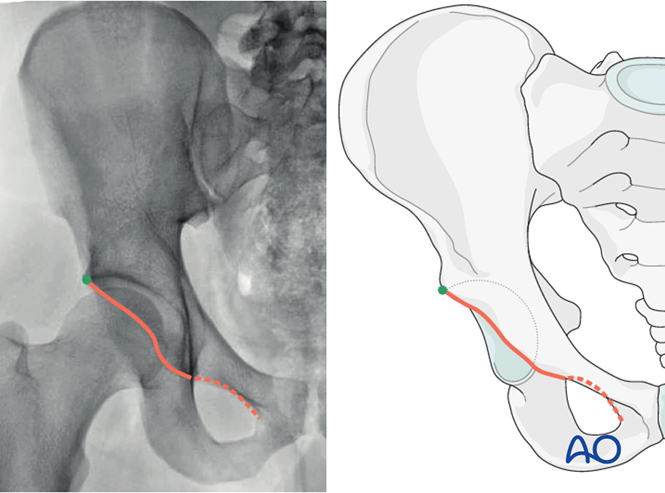 Radiology of the intact acetabulum