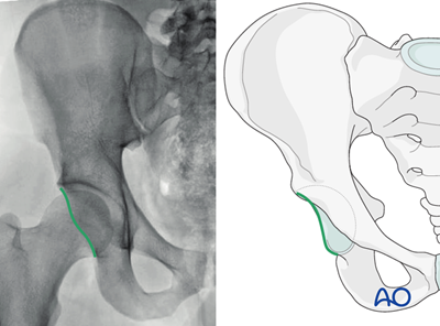 Radiology of the intact acetabulum