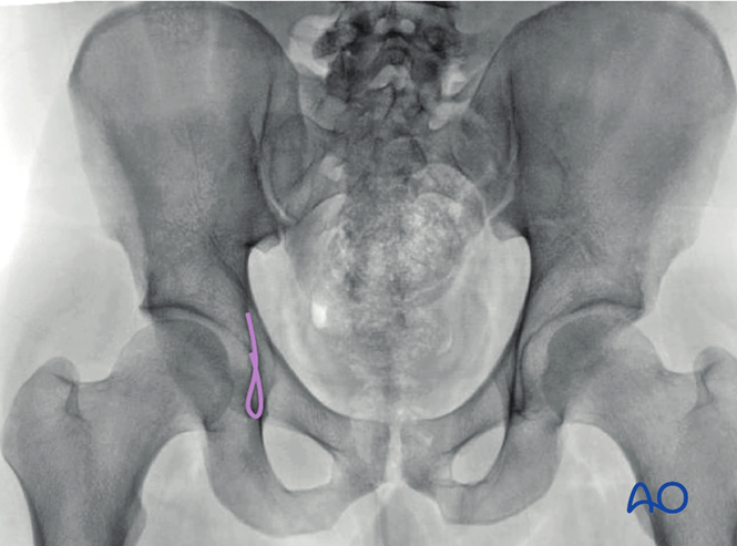 Radiology of the intact acetabulum