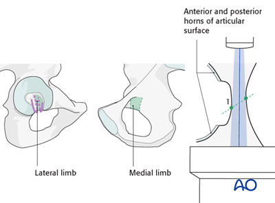 Radiology of the intact acetabulum