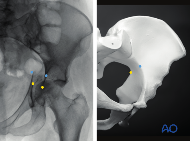Radiology of the intact acetabulum