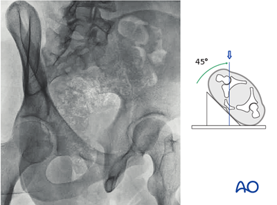 Radiology of the intact acetabulum