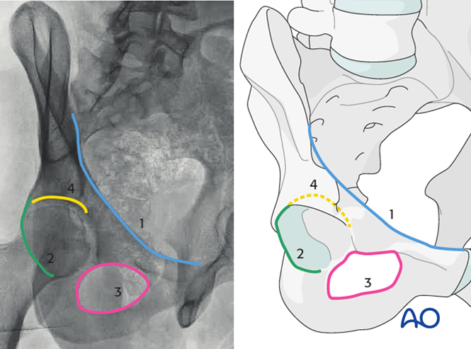 Radiology of the intact acetabulum