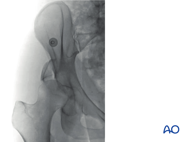 Radiology of the intact acetabulum