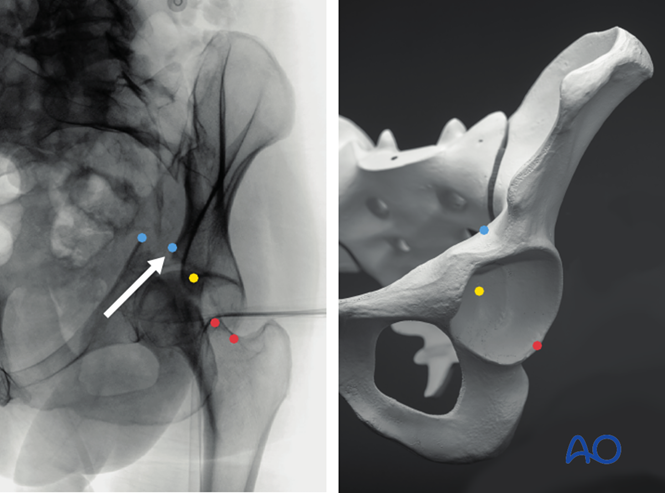 Radiology of the intact acetabulum