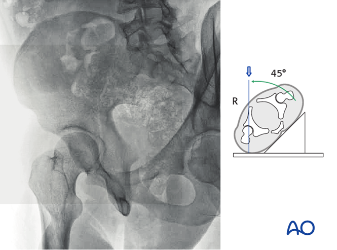 Radiology of the intact acetabulum