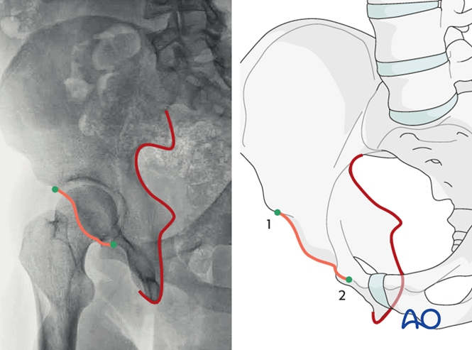 Radiology of the intact acetabulum