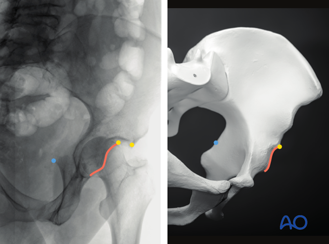 Radiology of the intact acetabulum