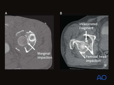 Radiology of the intact acetabulum