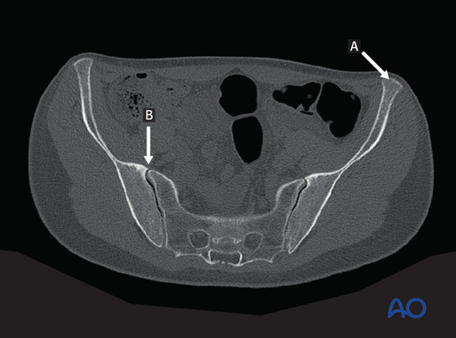 Radiology of the intact acetabulum