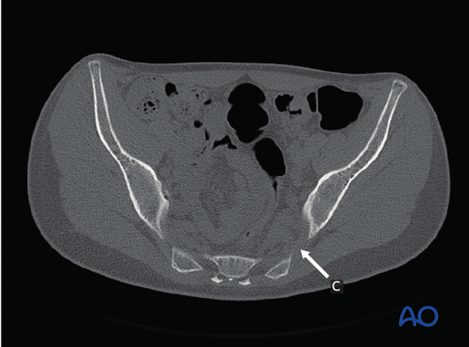 Radiology of the intact acetabulum