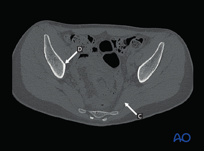 Radiology of the intact acetabulum