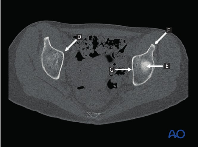 Radiology of the intact acetabulum