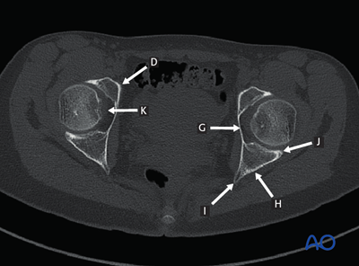 Radiology of the intact acetabulum