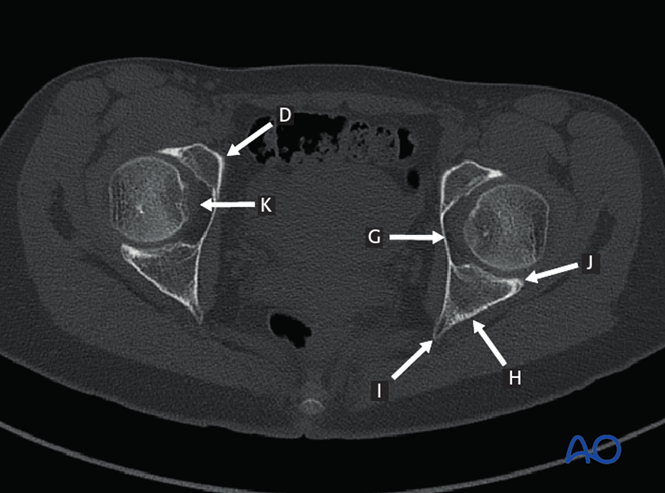 Radiology of the intact acetabulum