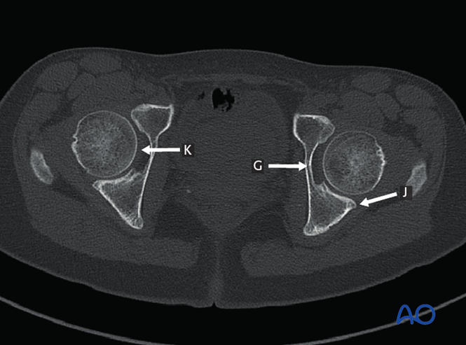 Radiology of the intact acetabulum
