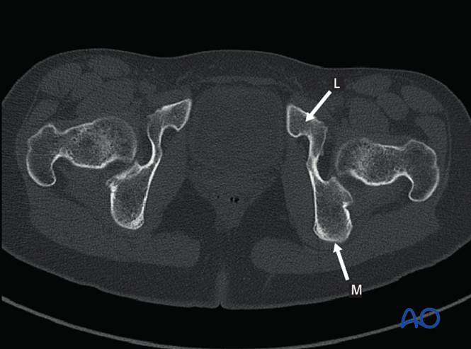 Radiology of the intact acetabulum