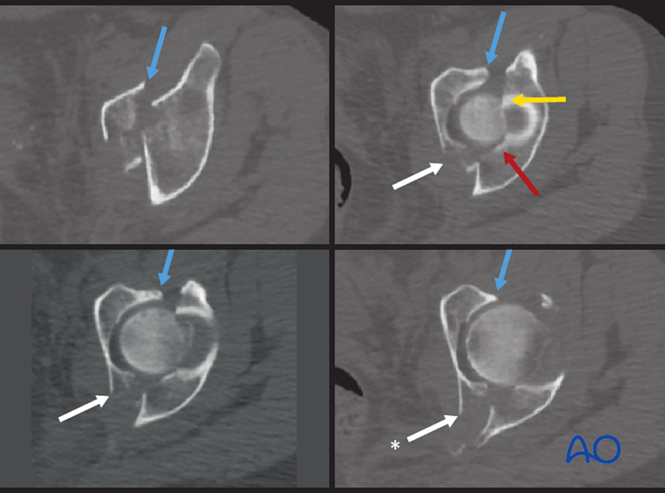 Radiology of the intact acetabulum