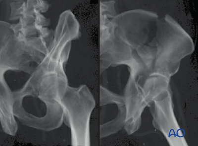 Radiology of the intact acetabulum