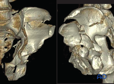 Radiology of the intact acetabulum