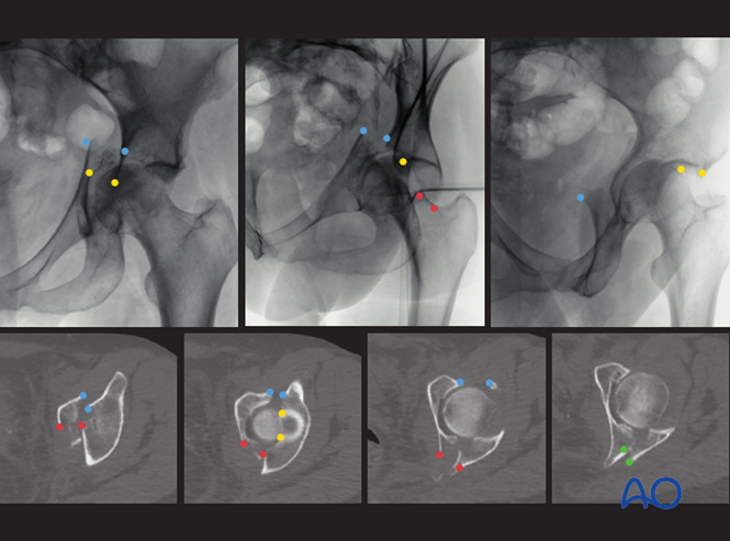 Radiology of the intact acetabulum