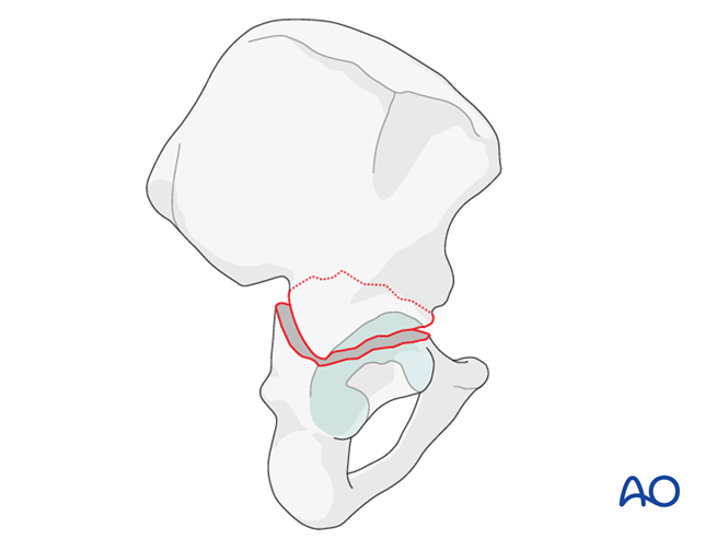 Radiology of the intact acetabulum